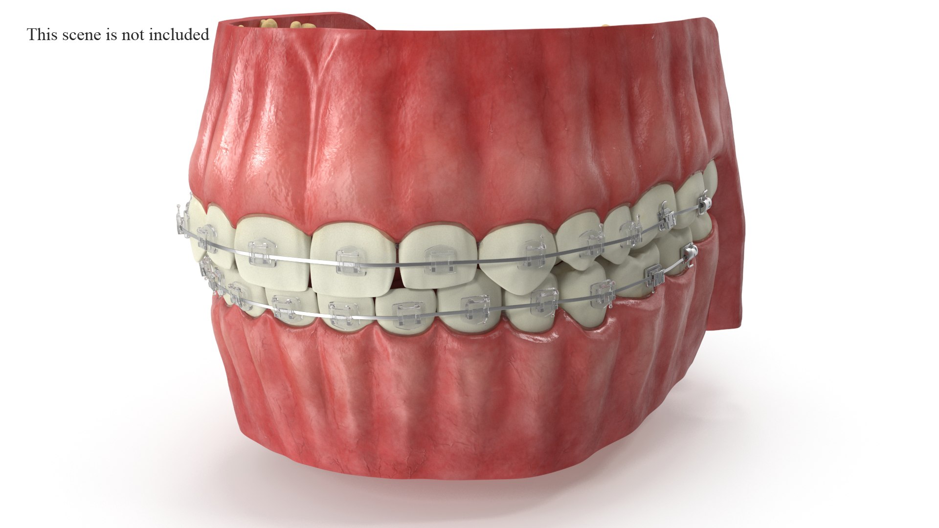 Self Ligating Transparent Dental Braces V02 3D model - TurboSquid 2170240