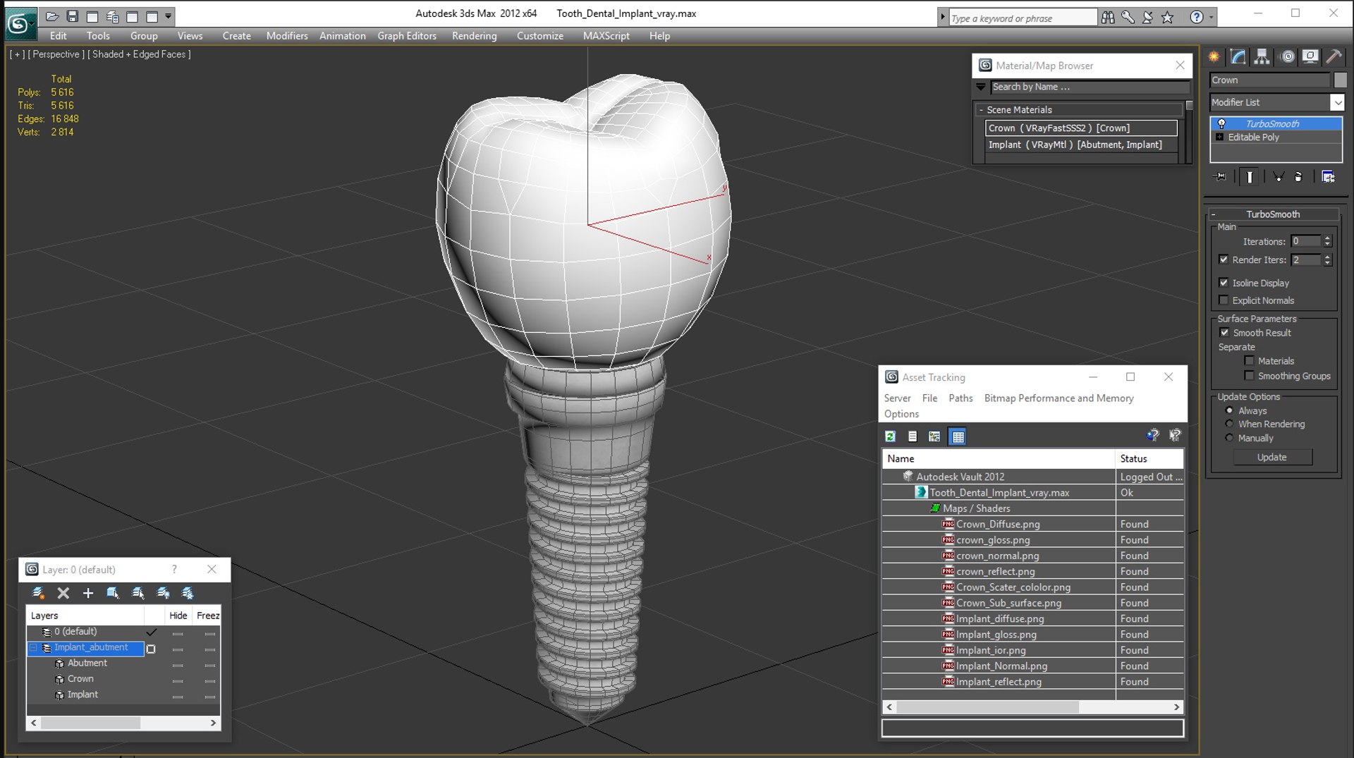 3D tooth dental implant - TurboSquid 1428834