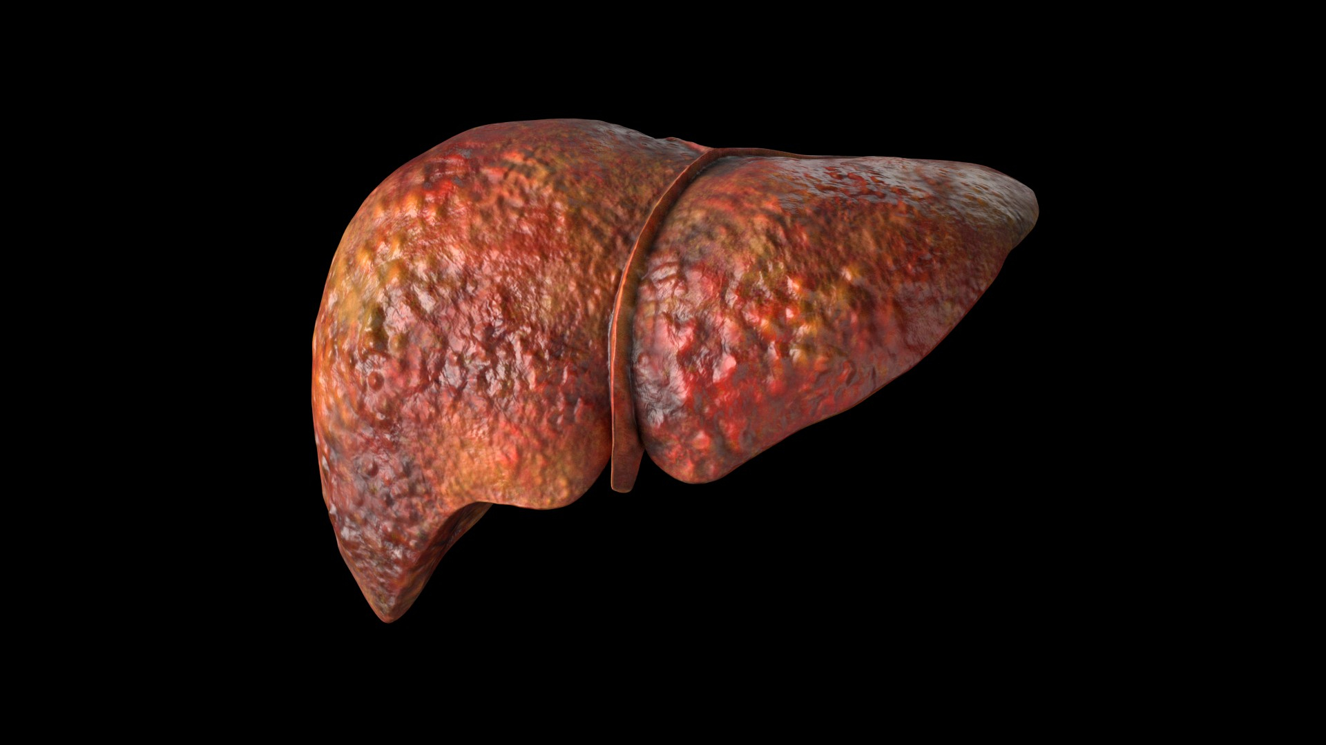 modelo 3d Hígado humano dañado - TurboSquid 1735319