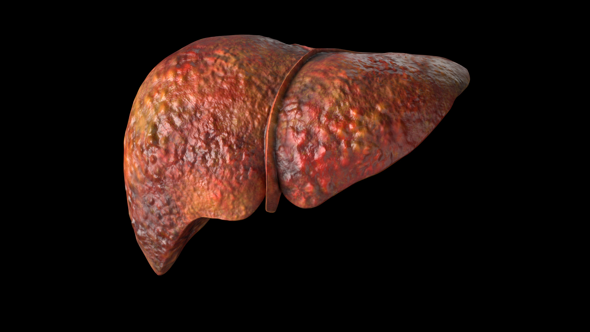 Human Liver Damaged 3D - TurboSquid 1735319