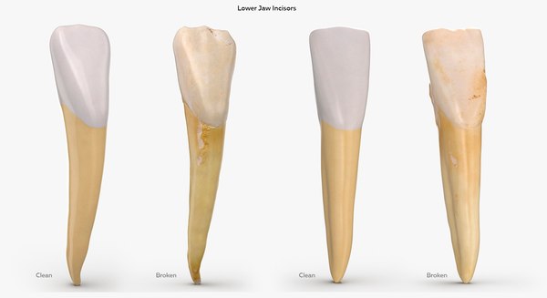 3D model Human Lower Jaw Incisors Clean and Broken Collection - 6 ...