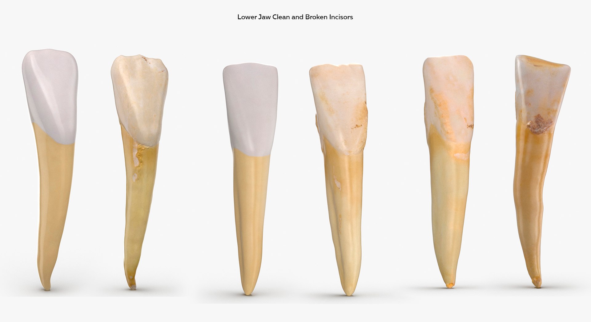 3D model Human Lower Jaw Incisors Clean and Broken Collection - 6 ...