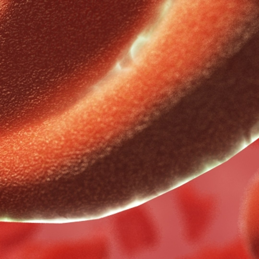 Sickle Cells Sickle-cell Anemia 3d Model