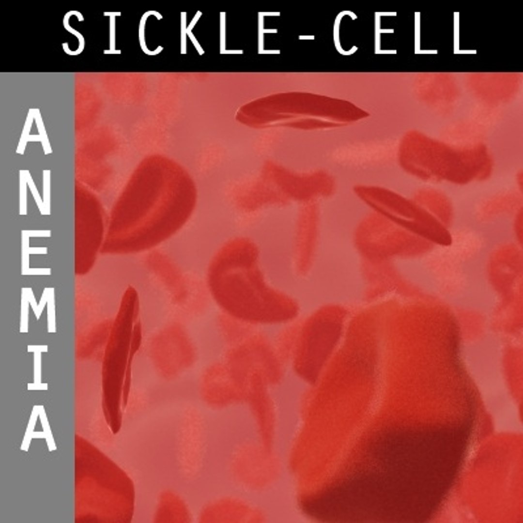 Sickle Cells Sickle-cell Anemia 3d Model