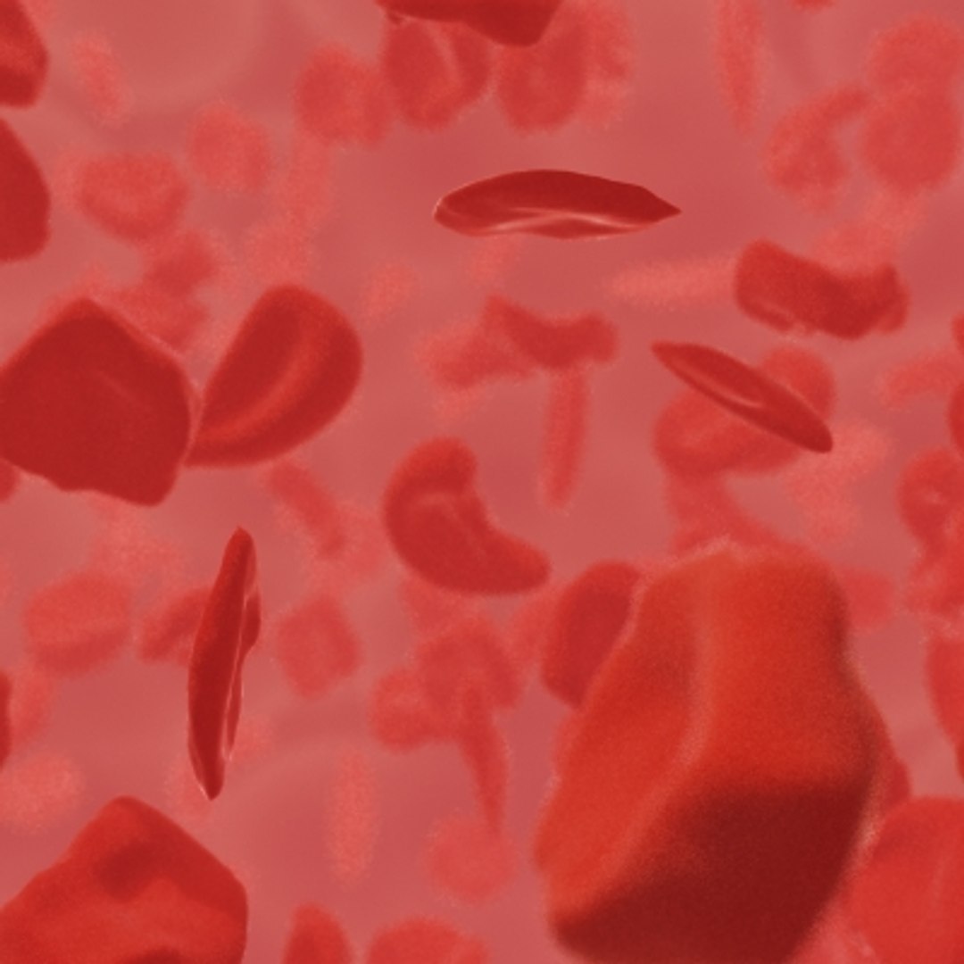 Sickle Cells Sickle-cell Anemia 3d Model