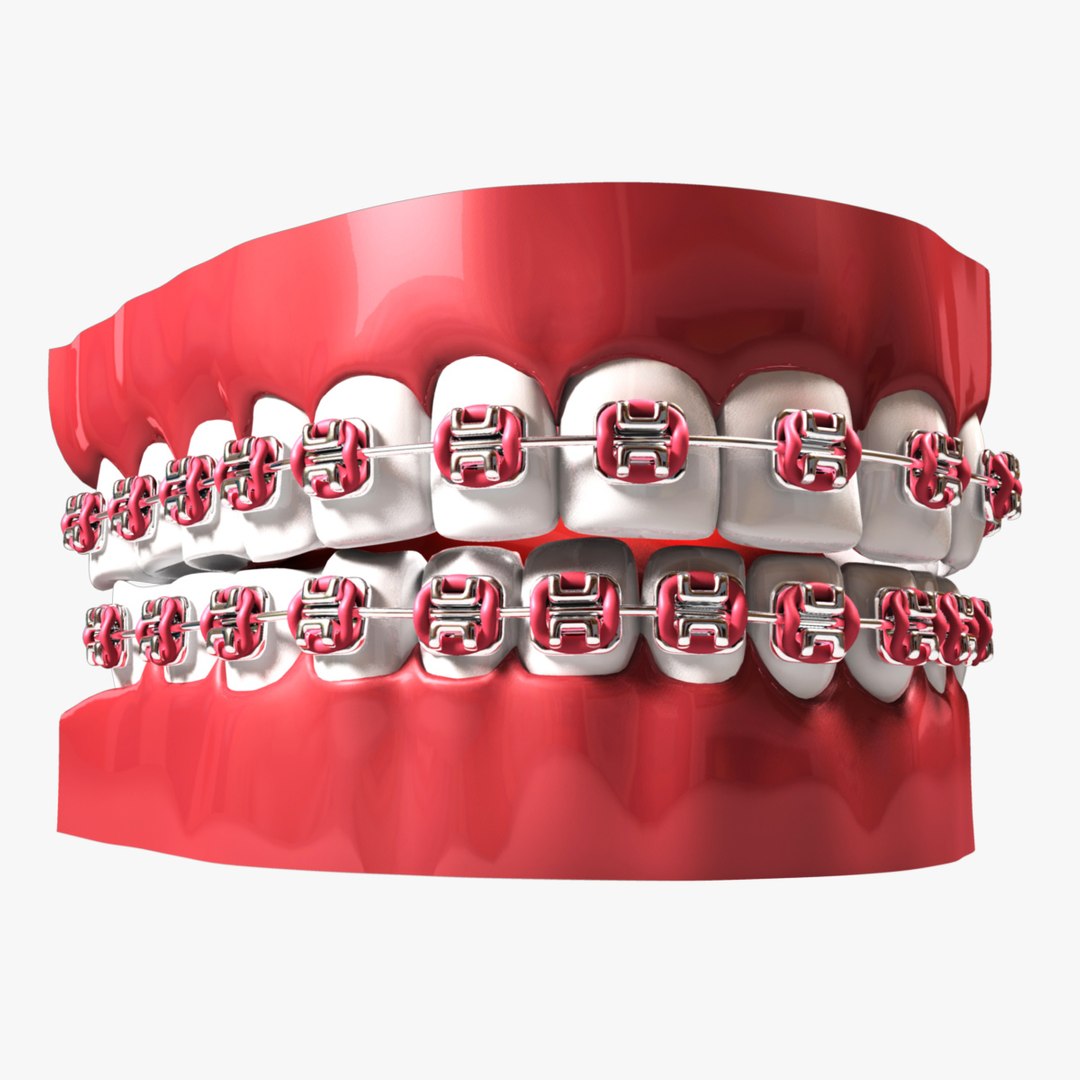 Teeth Braces 3d Model