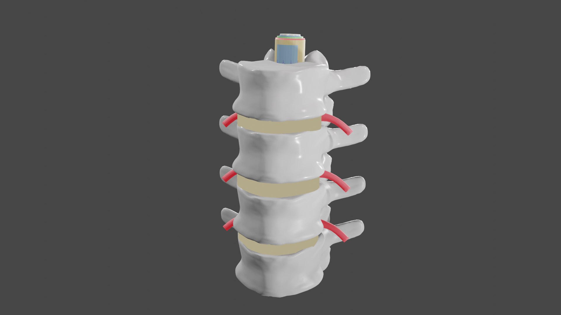 Protrusion Slipped Disc Herniated Model - TurboSquid 1572177