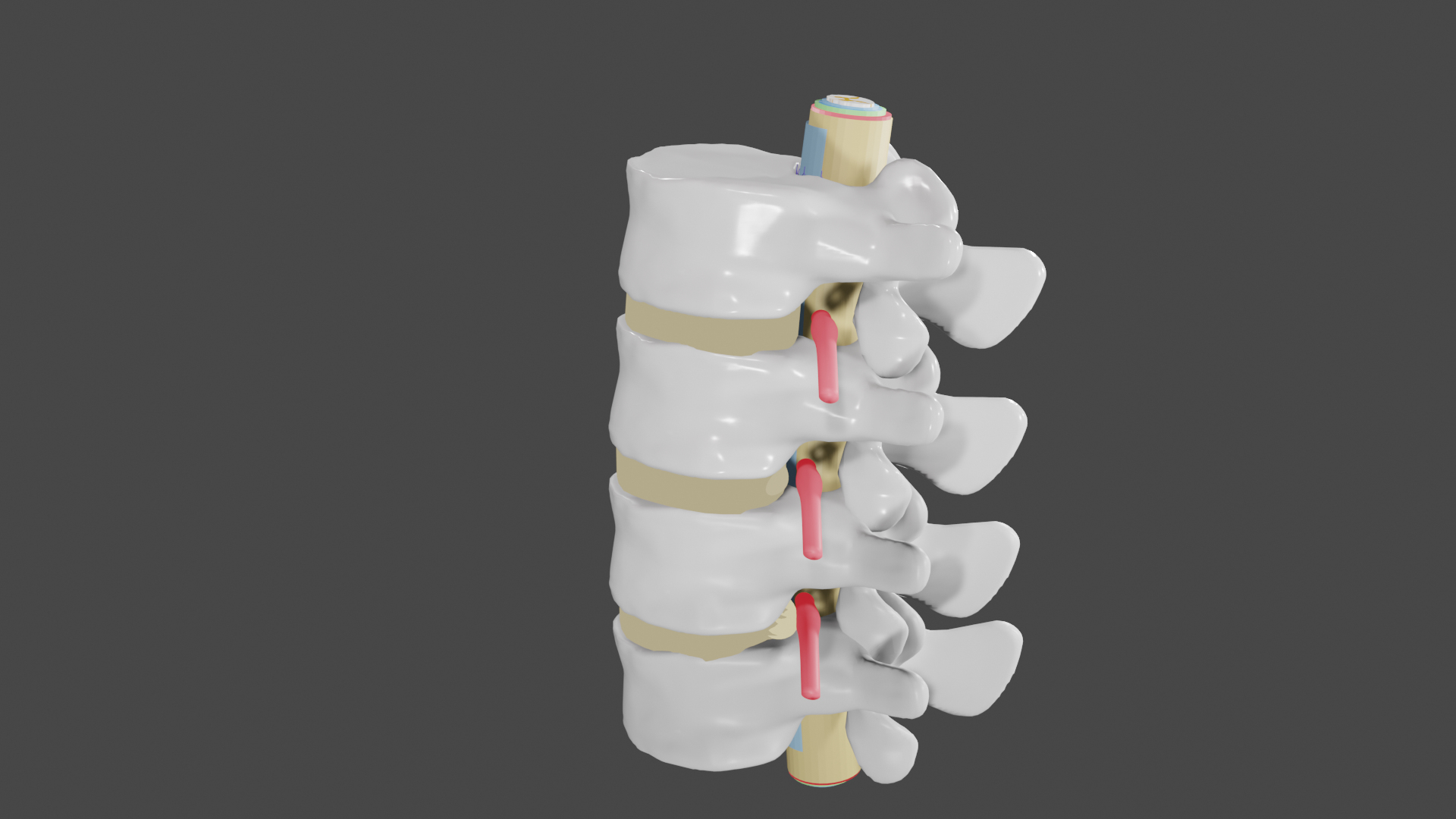 Protrusion Slipped Disc Herniated Model - TurboSquid 1572177