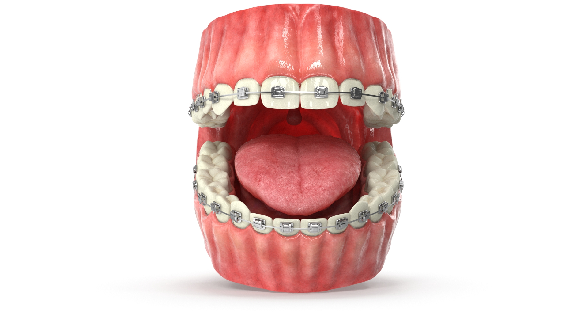 3D Human Mouth With Self Ligating Steel Dental Braces V02 Model ...