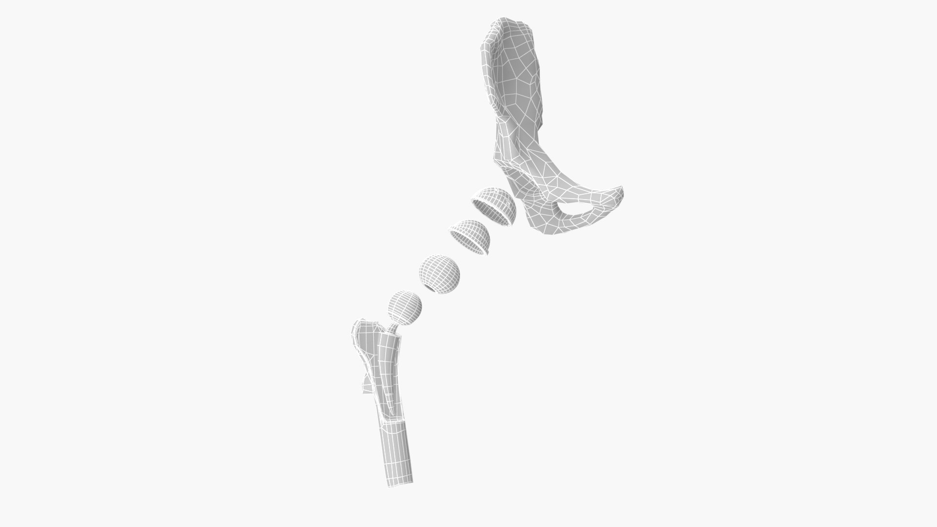 3D Hip Bone Replacement Surgery V01 - TurboSquid 1744808