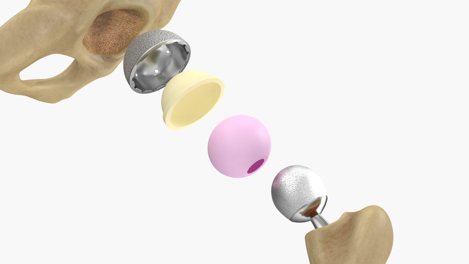 3D Hip Bone Replacement Surgery V01 - TurboSquid 1744808