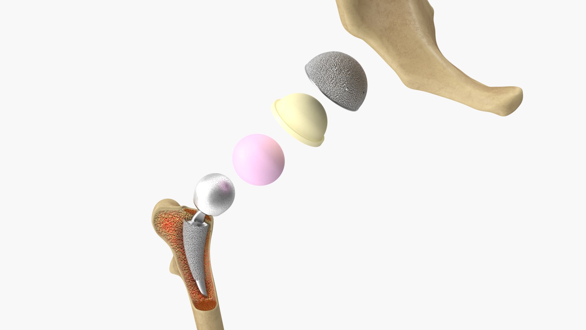 3D Hip Bone Replacement Surgery V01 - TurboSquid 1744808