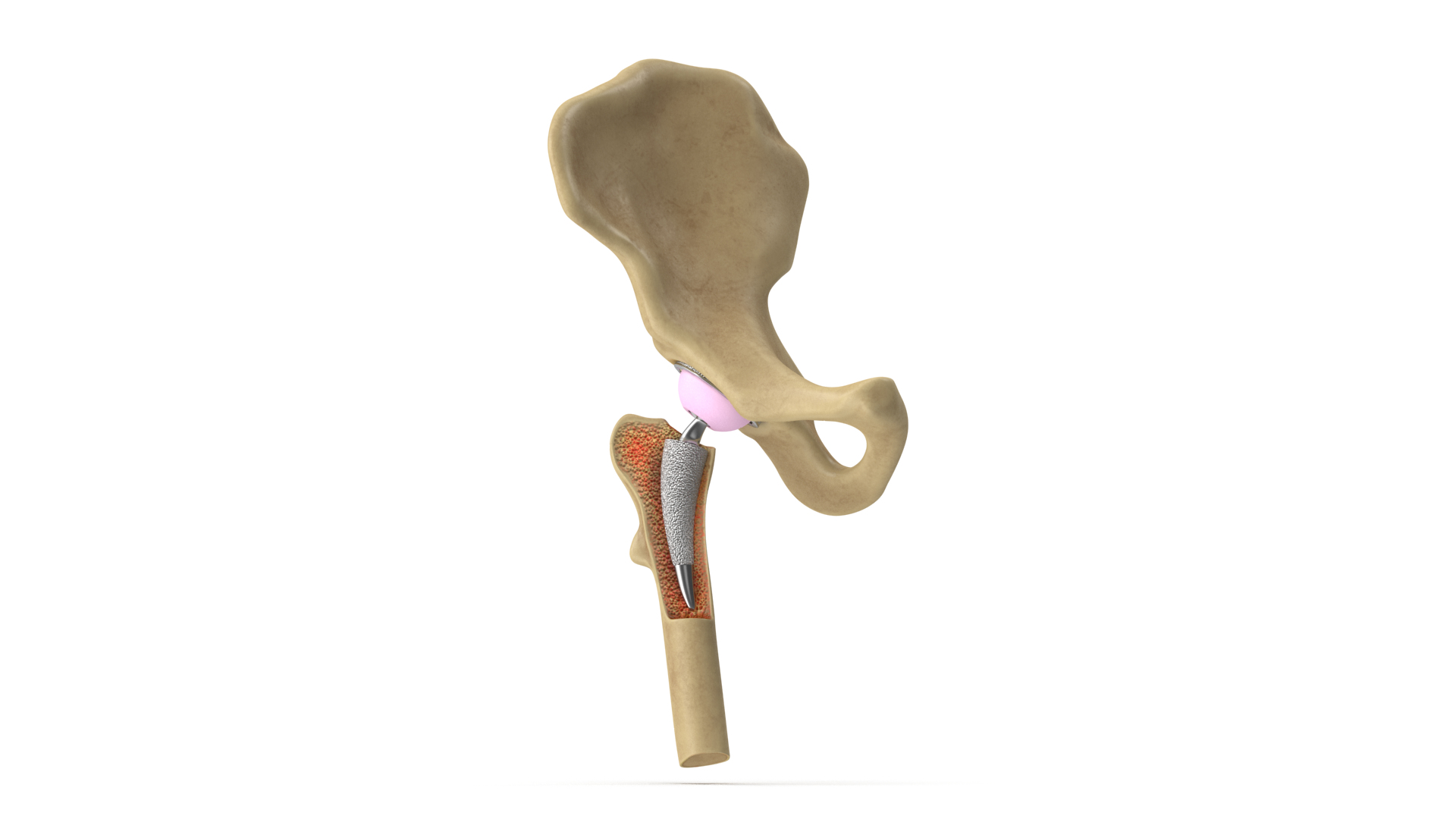 3D Hip Bone Replacement Surgery V01 - TurboSquid 1744808