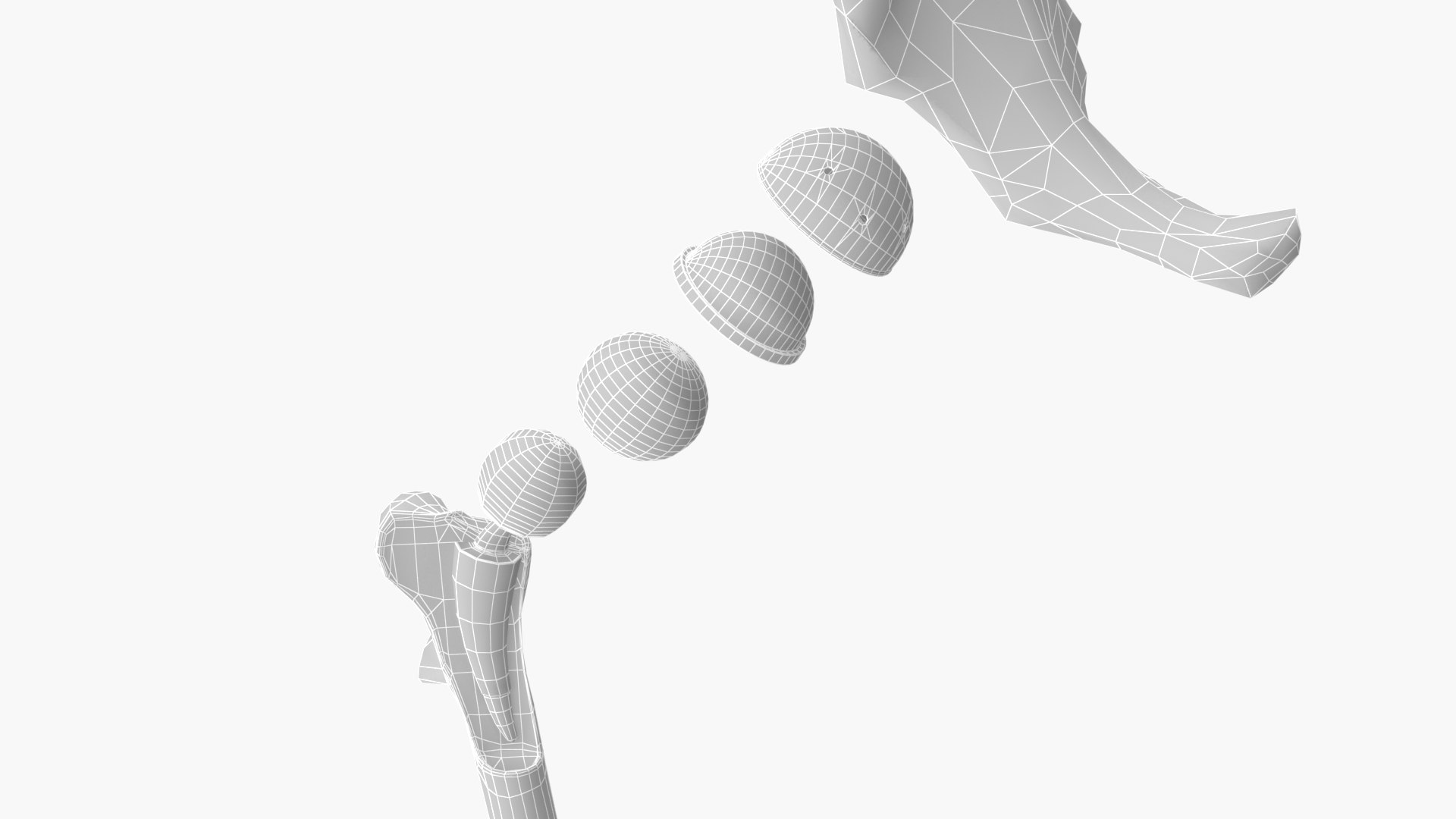 3D Hip Bone Replacement Surgery V01 - TurboSquid 1744808