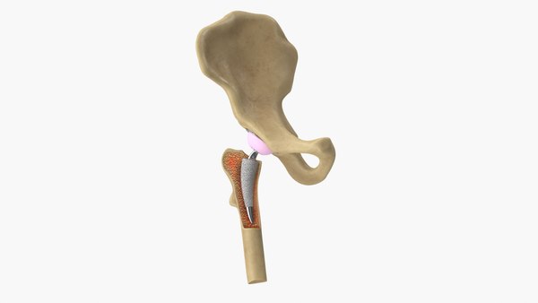 3D Hip Bone Replacement Surgery V01 - TurboSquid 1744808