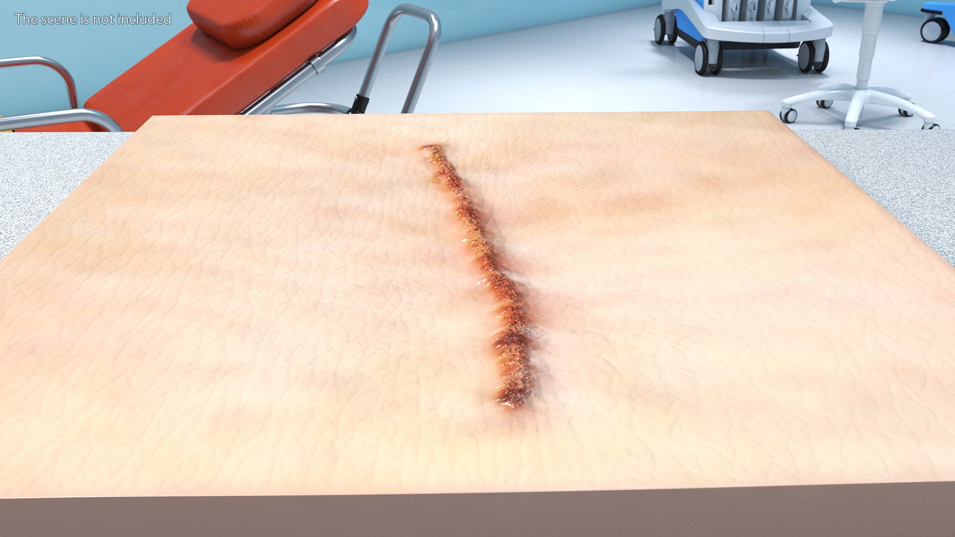 Medical Suture Closed On Skin 3D - TurboSquid 2161381