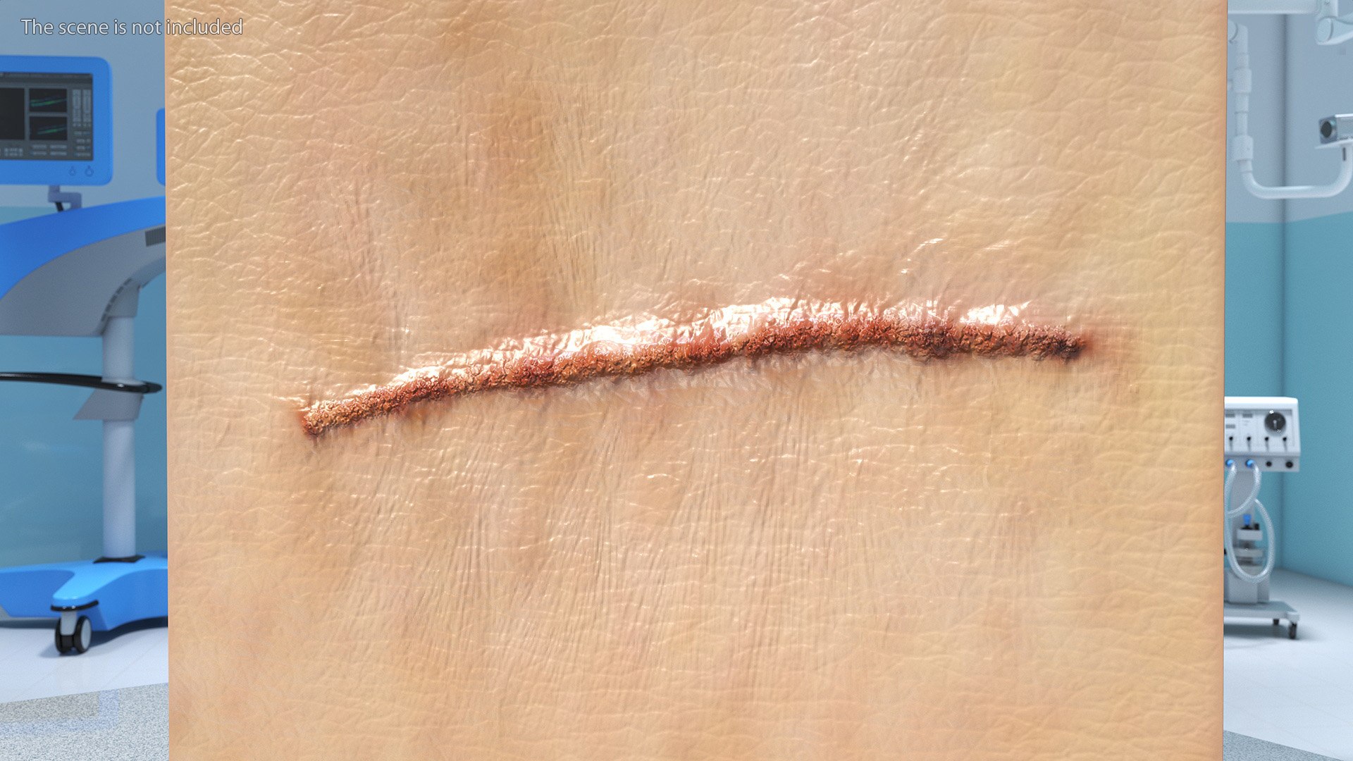 Medical Suture Closed On Skin 3D - TurboSquid 2161381