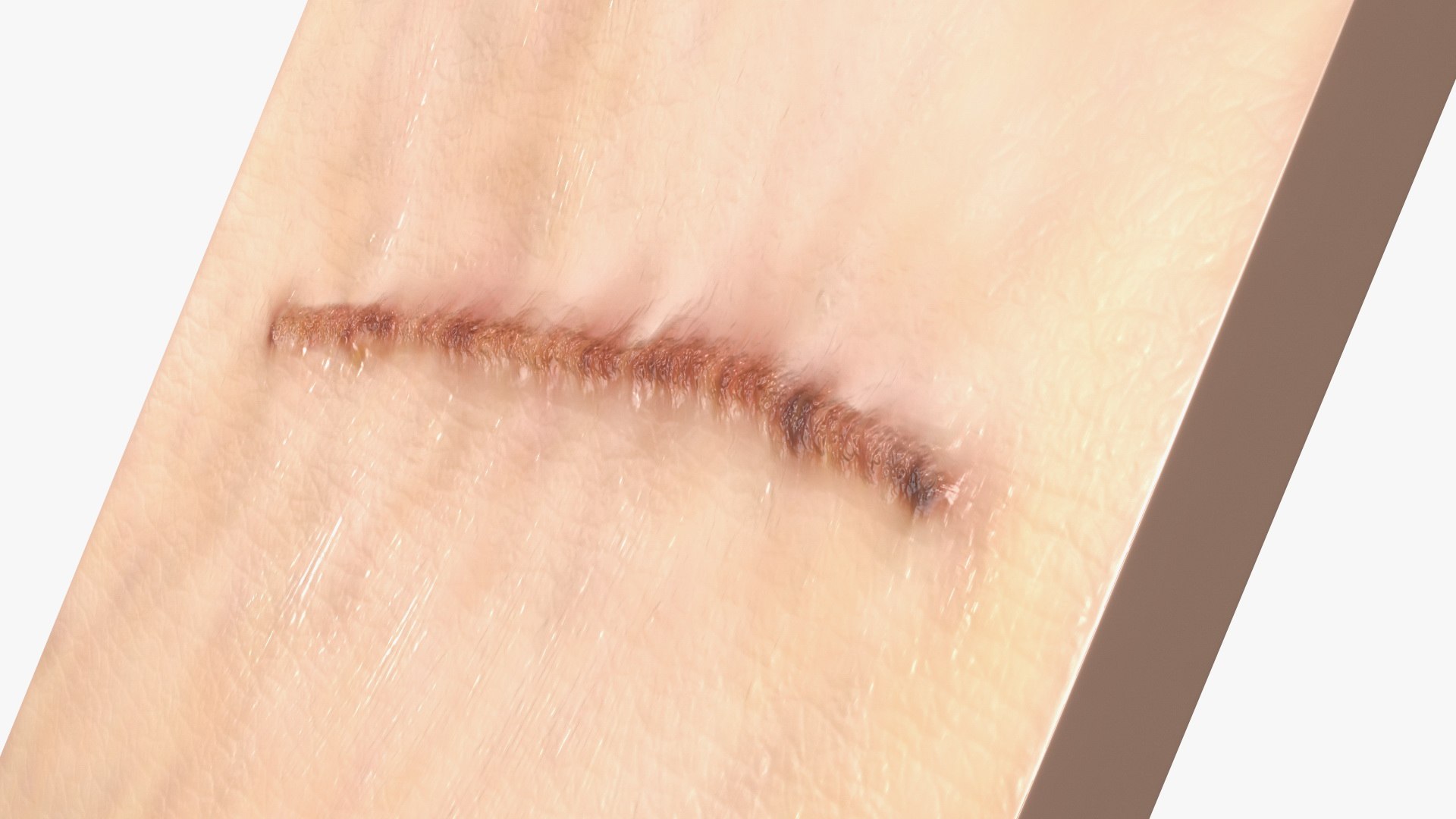 Medical Suture Closed On Skin 3D - TurboSquid 2161381