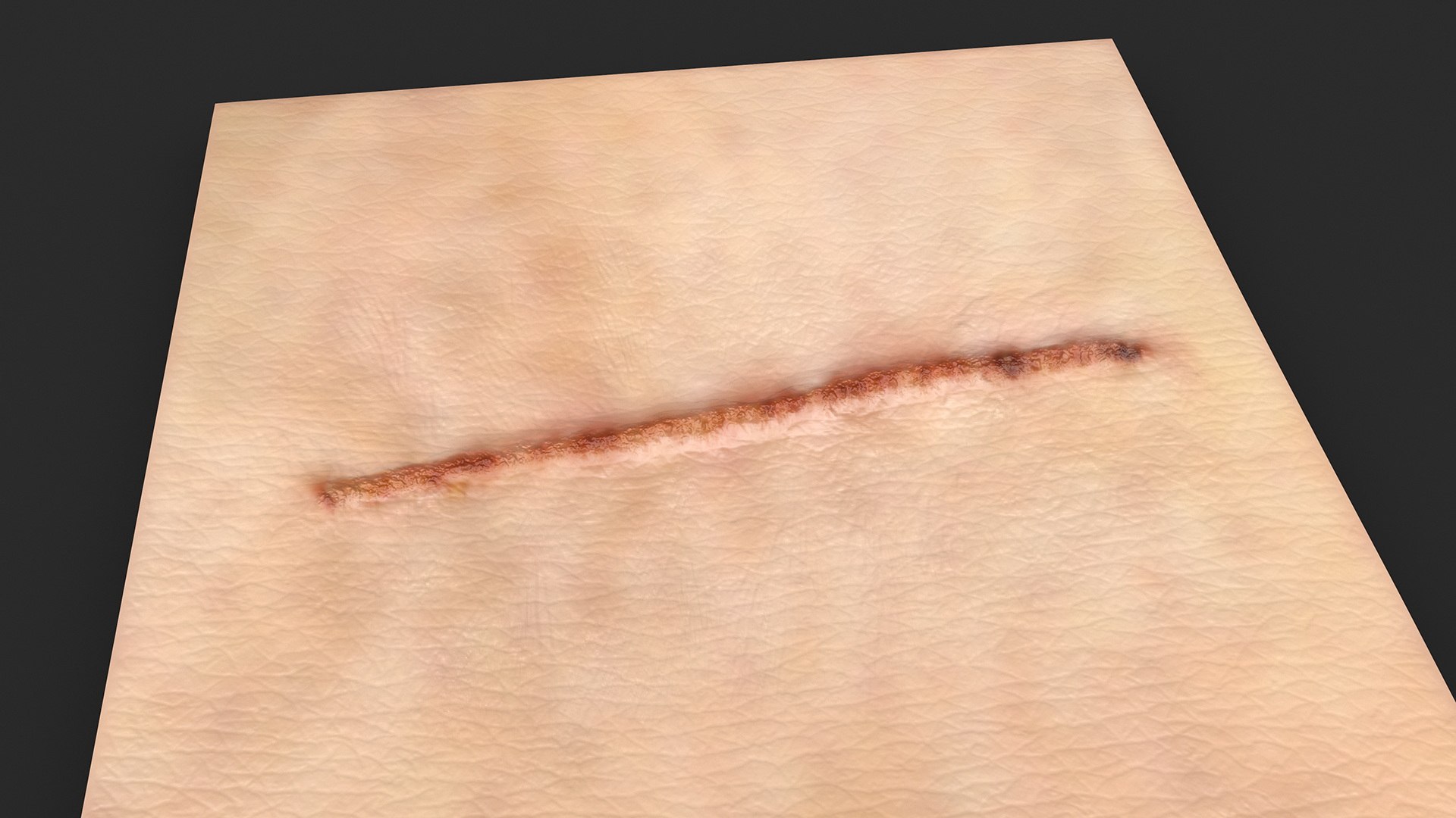 Medical Suture Closed On Skin 3D - TurboSquid 2161381