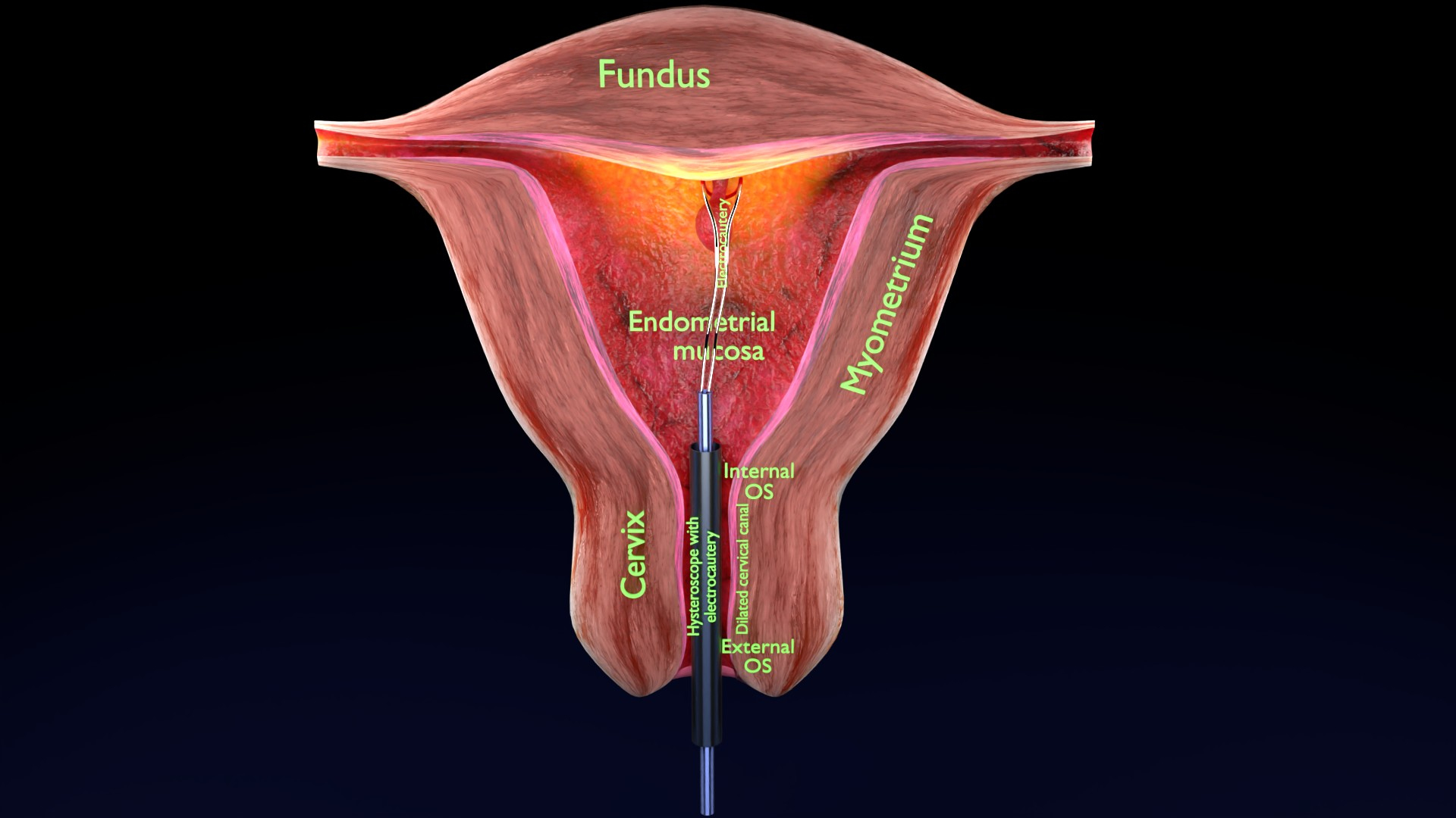 3D Endometrial Polyp Electrocautery Model - TurboSquid 2442265