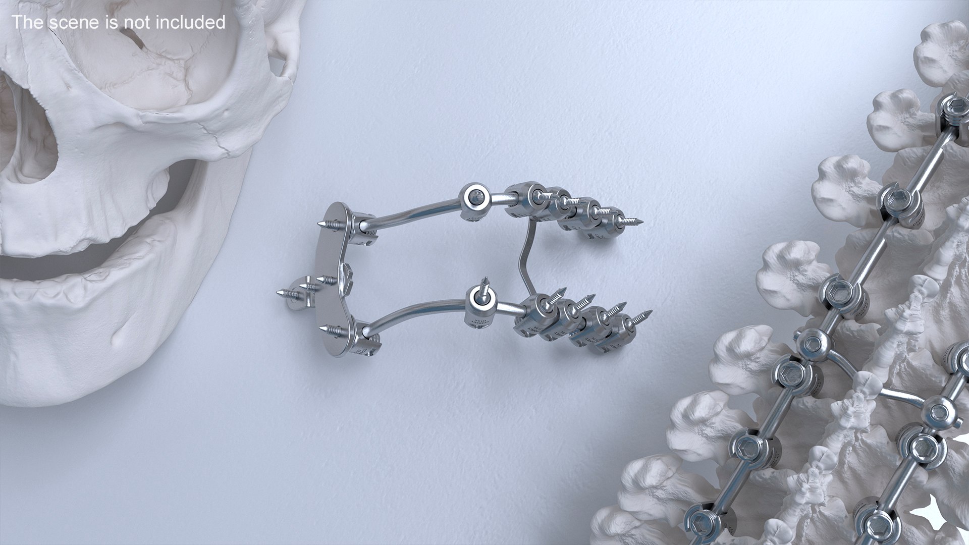 3D Posterior Cervical Spine Fixation System - TurboSquid 2205567