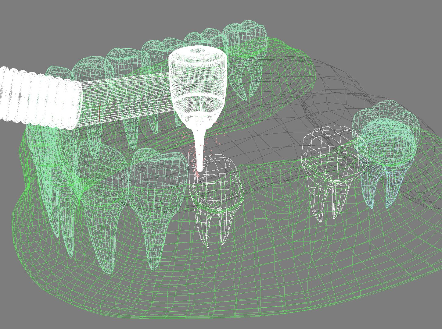 Dental Tooth Supported Fixed 3D Model - TurboSquid 1339421
