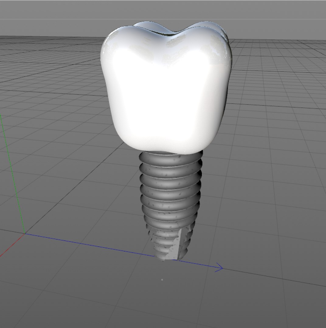 3D Tooth Implant Model - TurboSquid 1358549