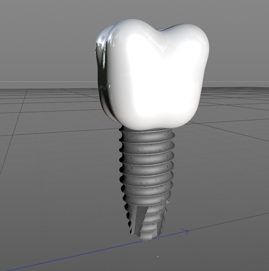 3D Tooth Implant Model - TurboSquid 1358549