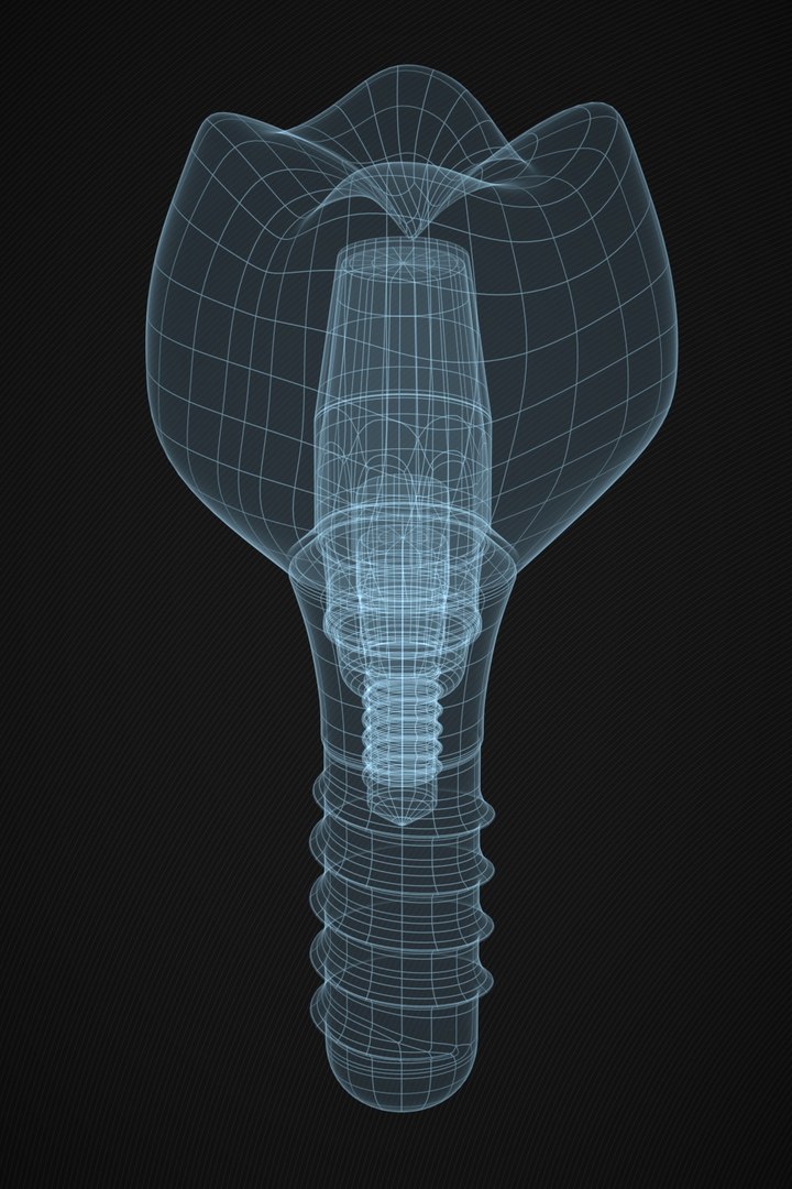 Dental Implant 3D Model - TurboSquid 1407952