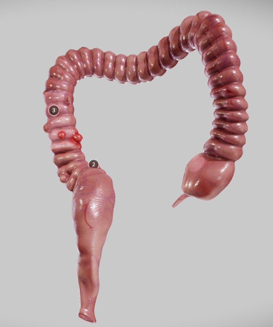 3D disease diverticulosis diverticulitis intestinal - TurboSquid 1613079