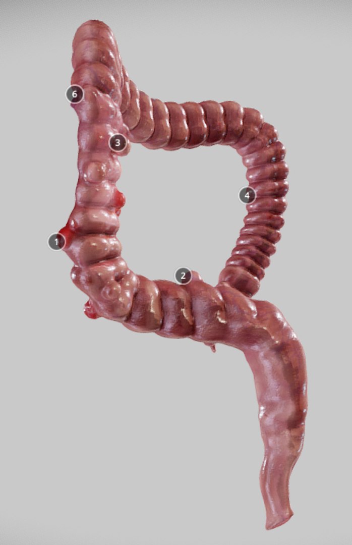 3D disease diverticulosis diverticulitis intestinal - TurboSquid 1613079
