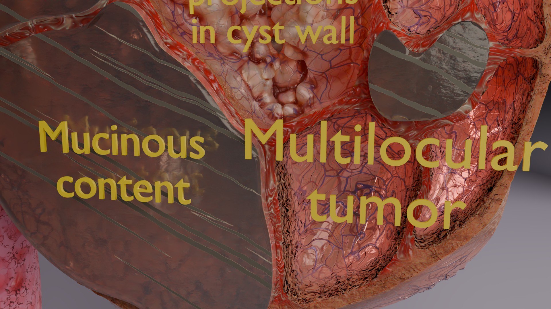3D Ovary Mucinous Cystic Tumor Model - TurboSquid 2460290
