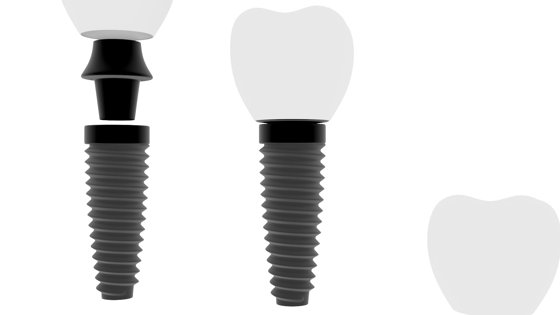 3D Tooth Implant Model - TurboSquid 2377546