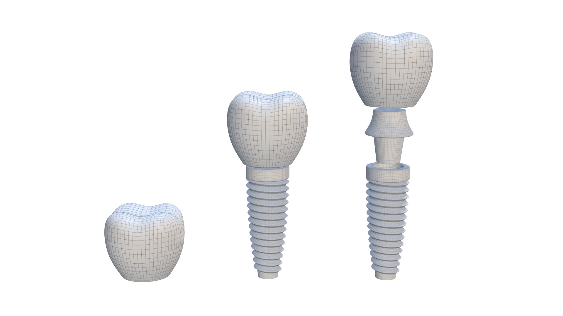 3D Tooth Implant Model - TurboSquid 2377546