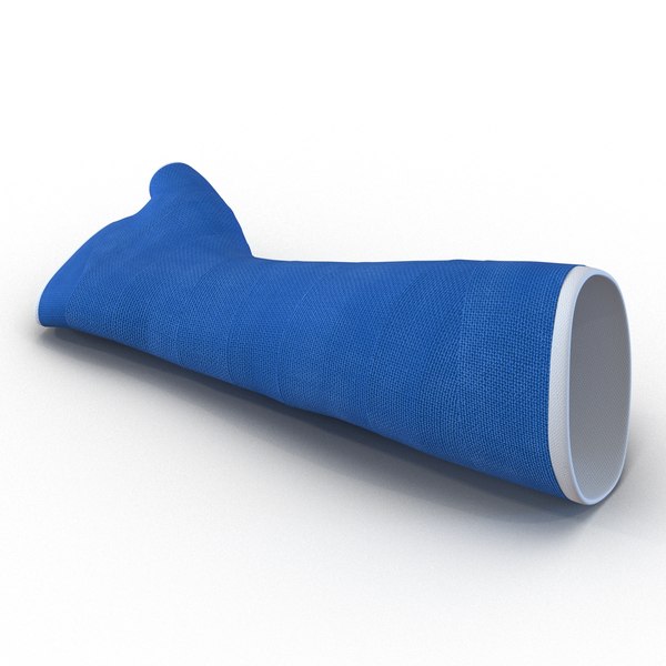 3d blue fiberglass cast arm