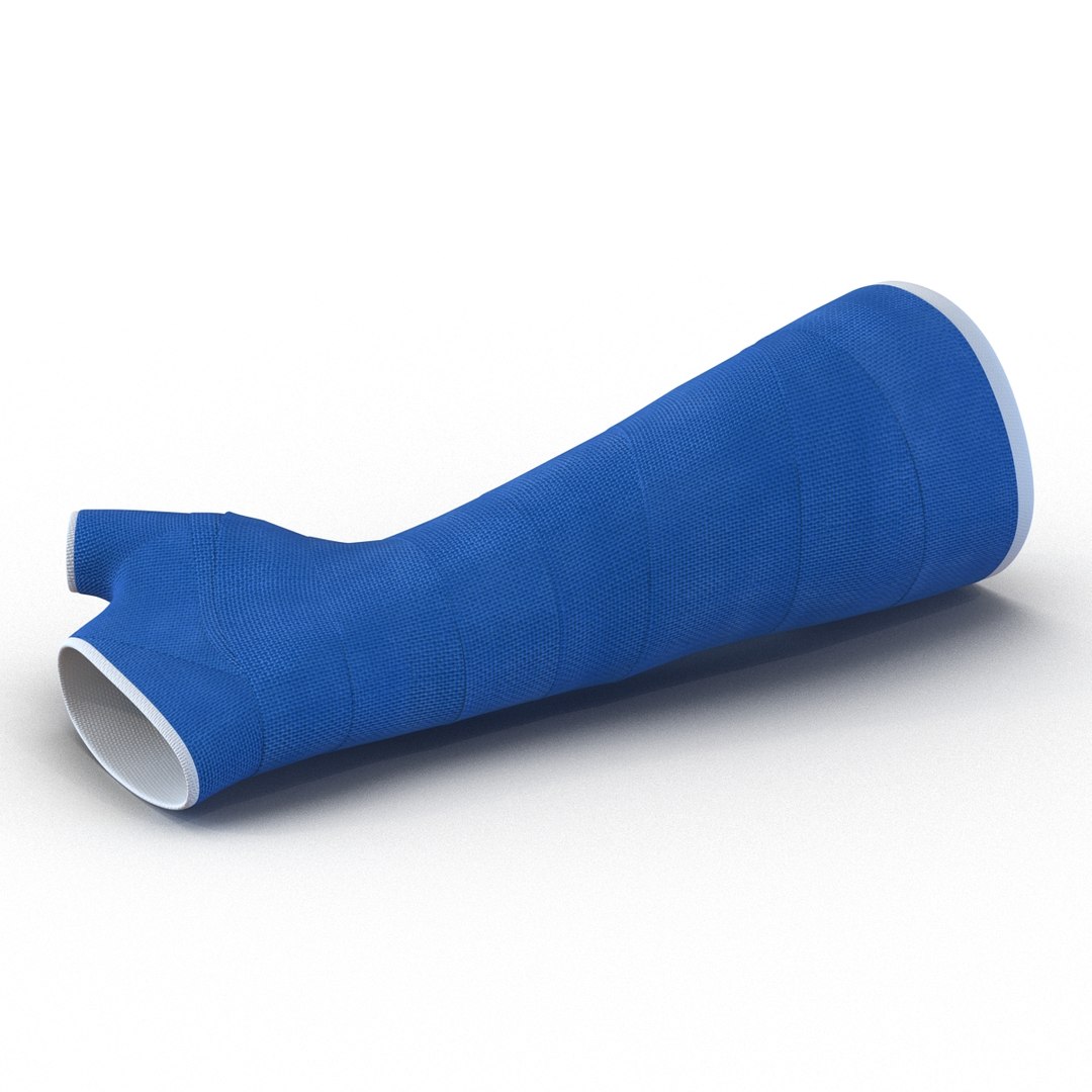 3d blue fiberglass cast arm