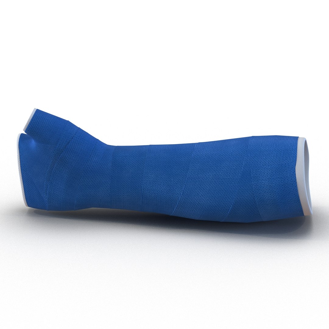 3d blue fiberglass cast arm