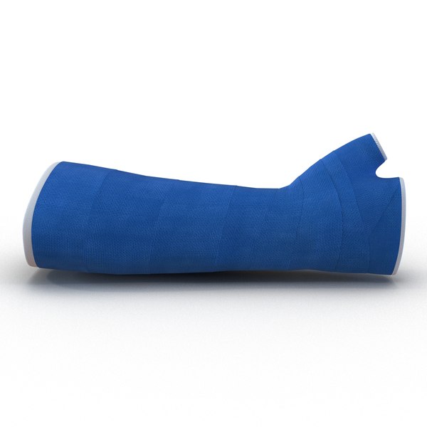 3d blue fiberglass cast arm
