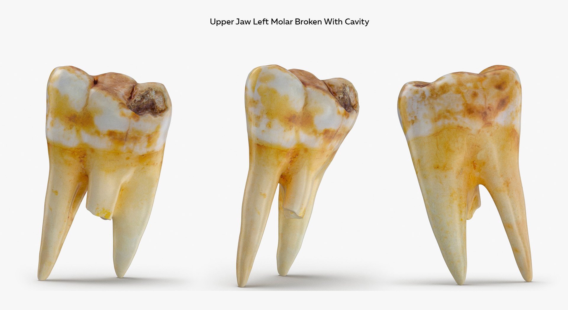 3D Human Broken Teeth Collection - 4 models - TurboSquid 1753812