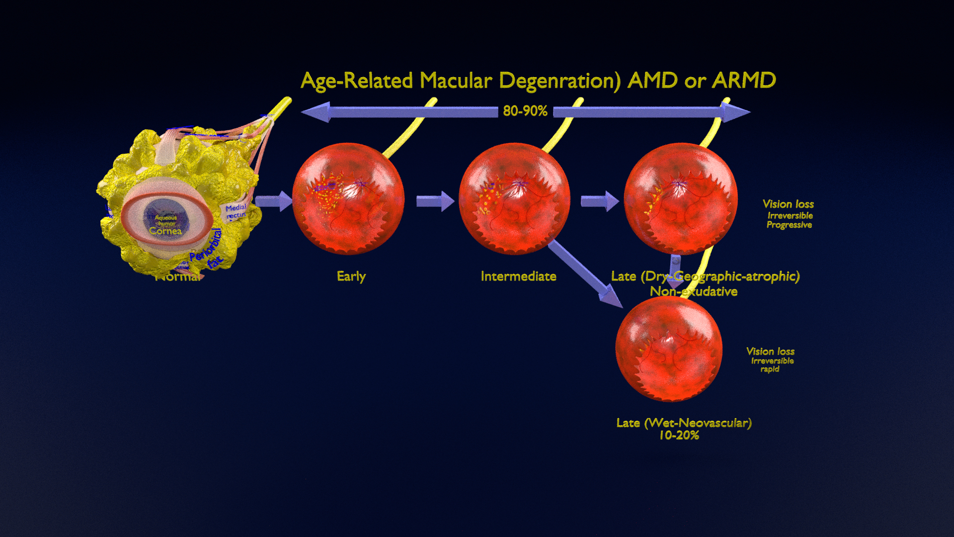 Age-related macular degeneration AMD ARMD detailed labelled animated ...