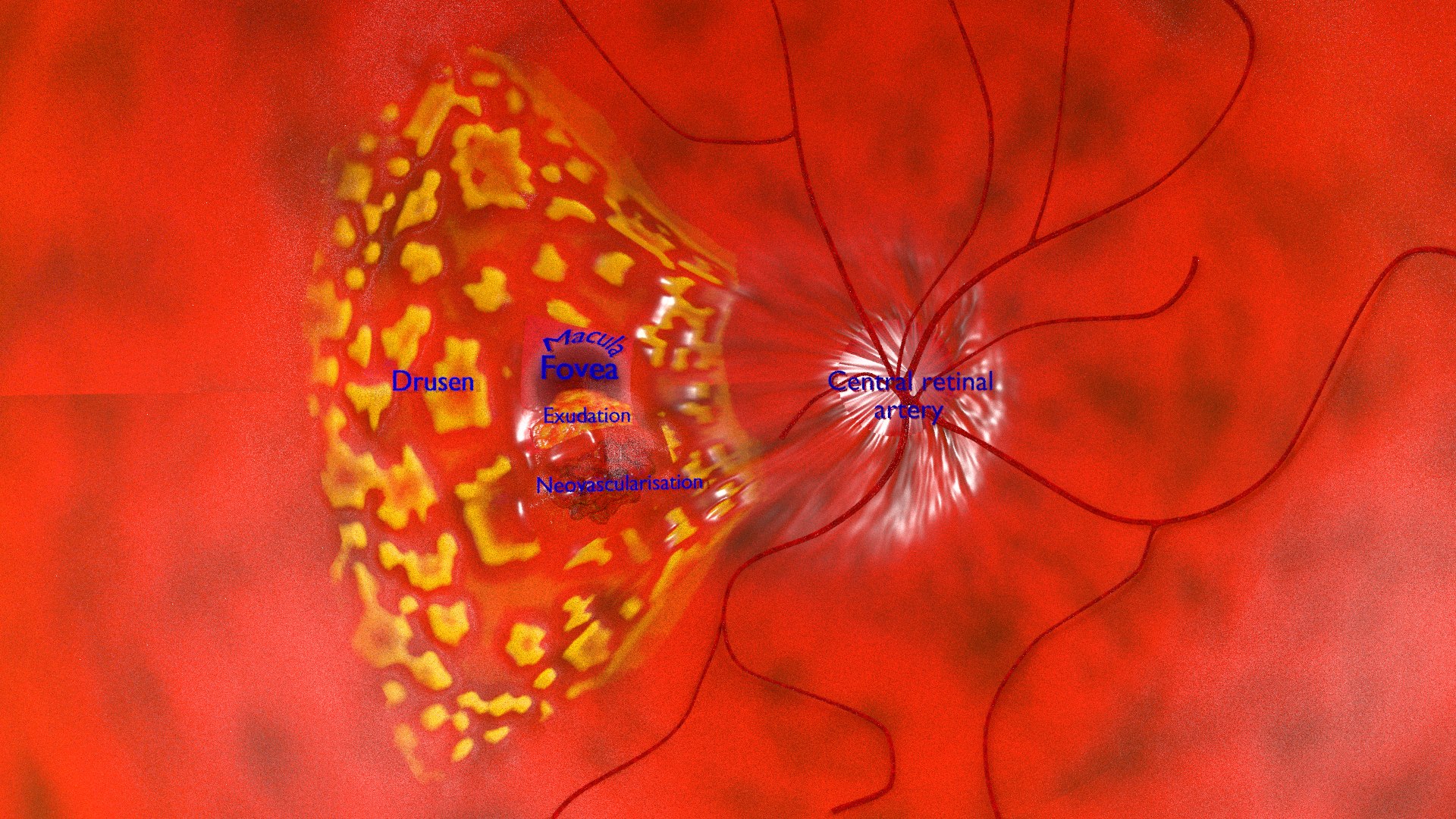 Age-related Macular Degeneration AMD ARMD Detailed Labelled Animated ...