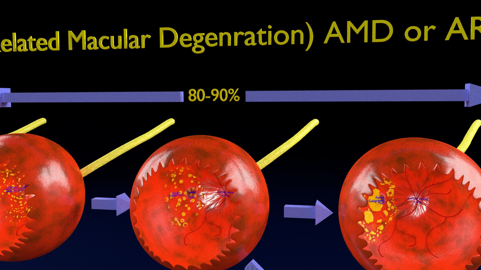 Age-related Macular Degeneration AMD ARMD Detailed Labelled Animated ...