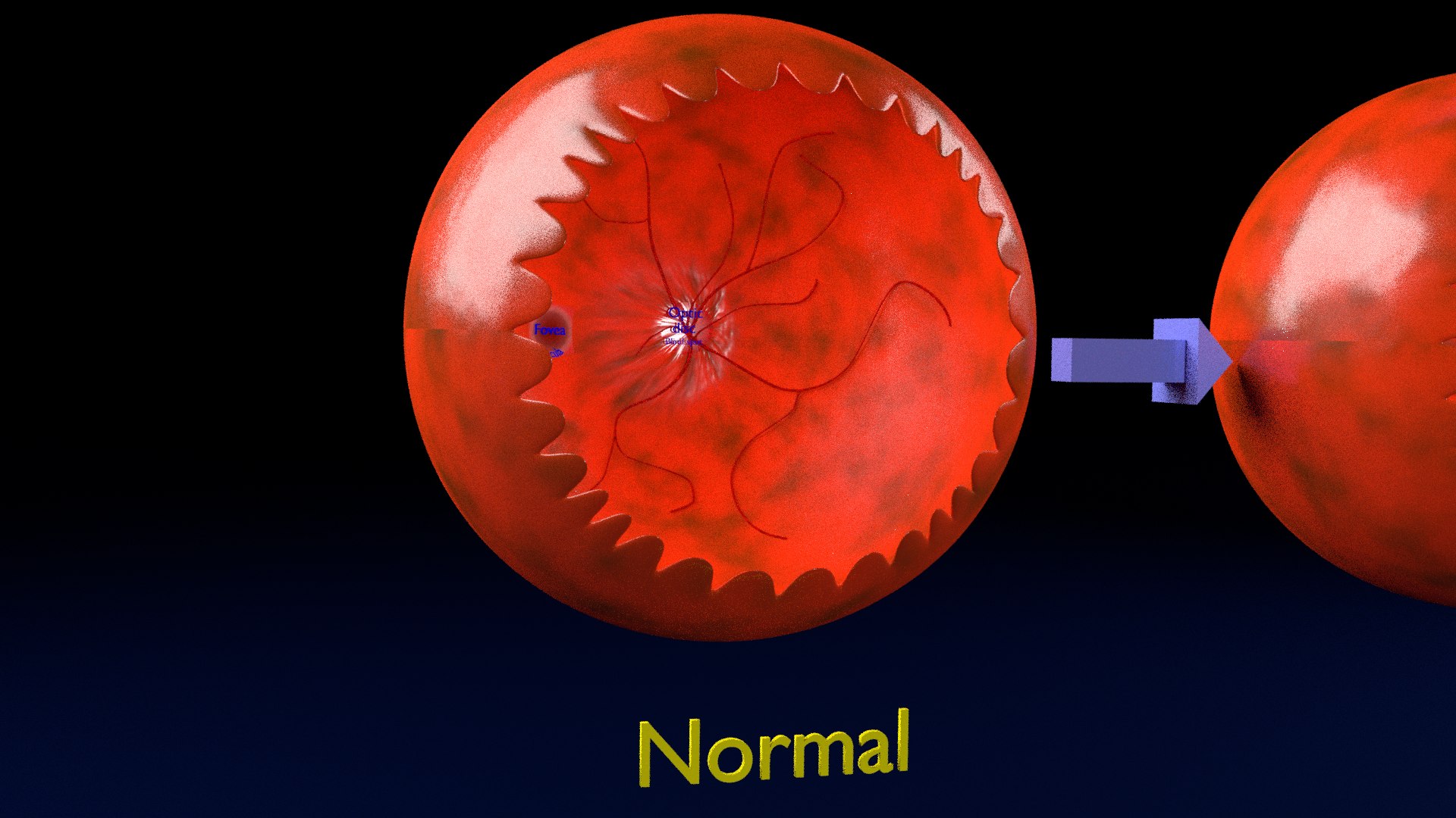 Age-related Macular Degeneration AMD ARMD Detailed Labelled Animated ...