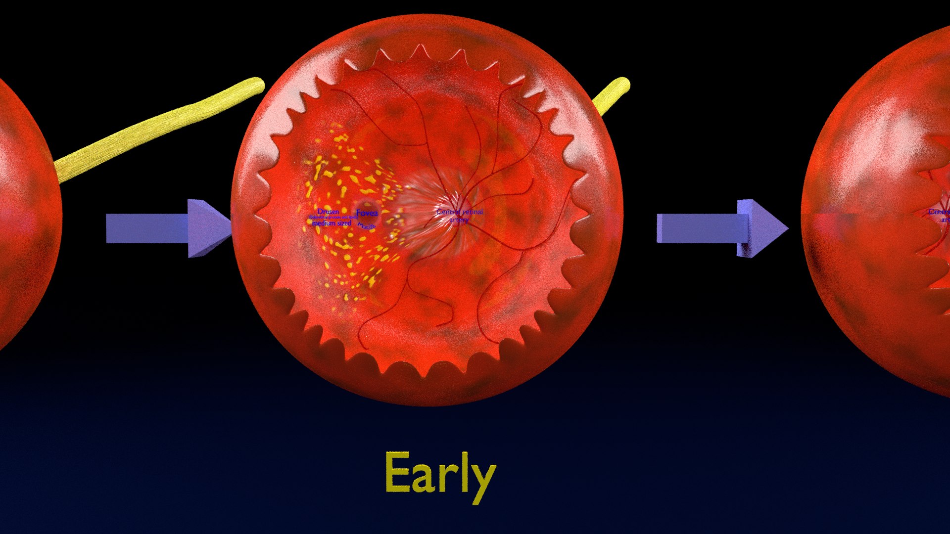 Age-related Macular Degeneration AMD ARMD Detailed Labelled Animated ...