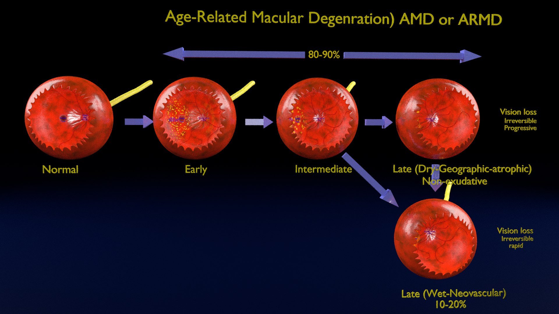 Age-related Macular Degeneration AMD ARMD Detailed Labelled Animated ...