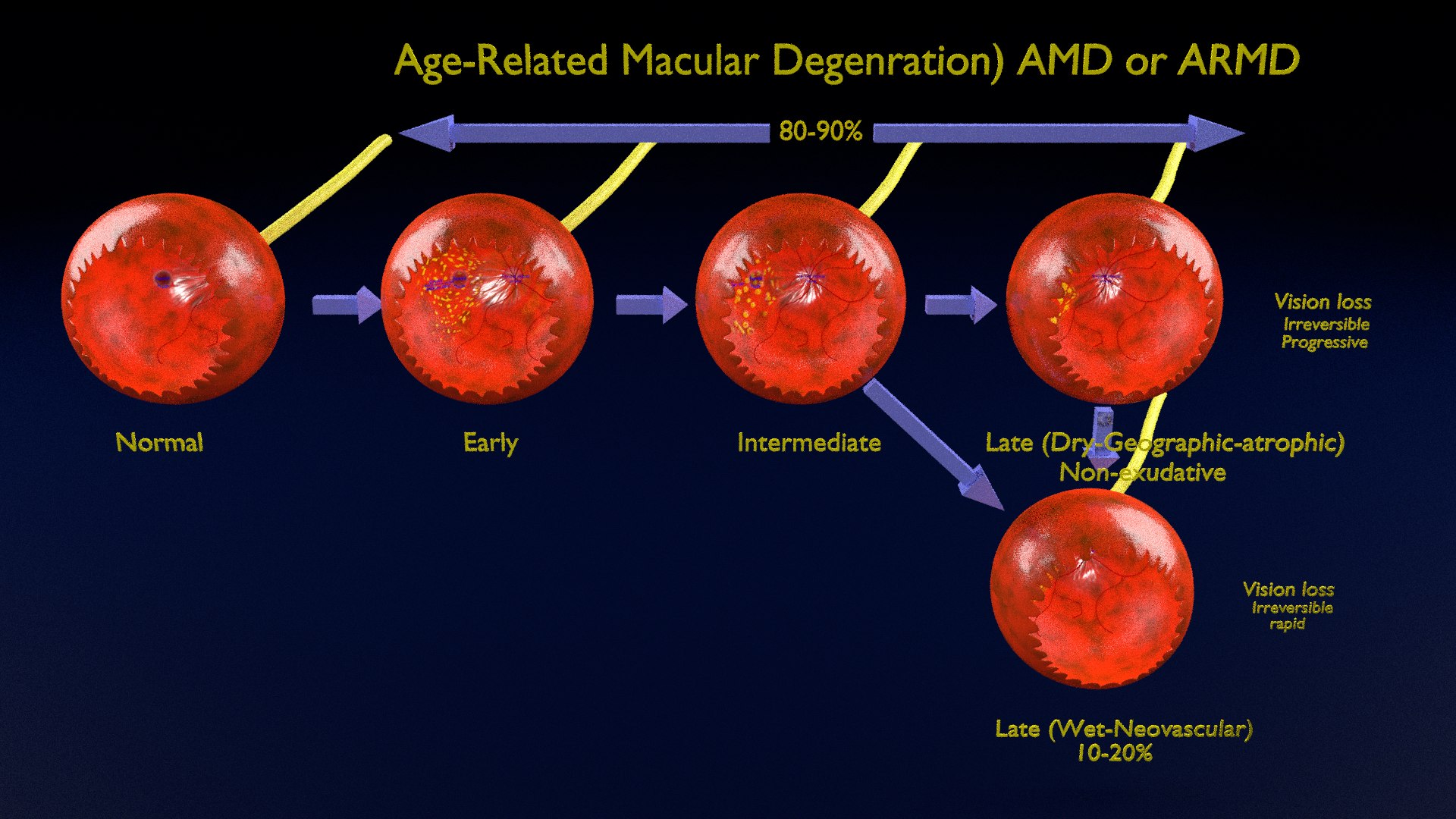 Age-related macular degeneration AMD ARMD detailed labelled animated ...