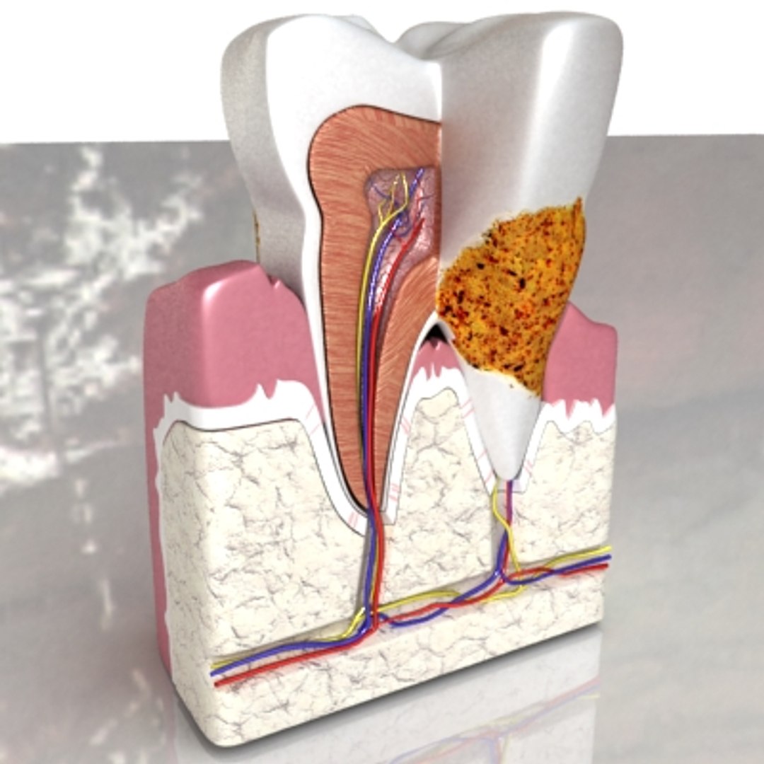 Tooth Dental Plaque 3d Model