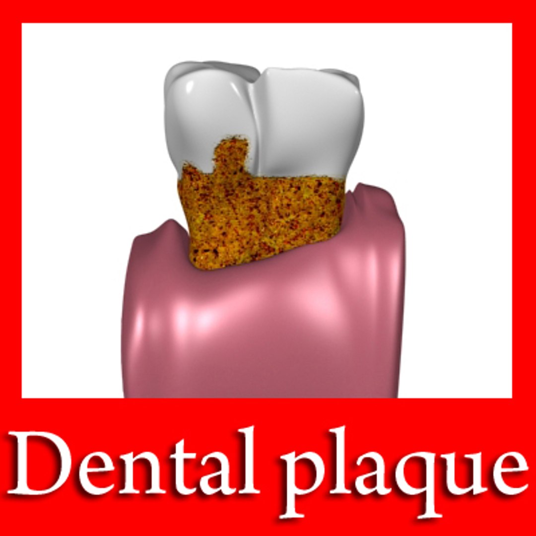 Tooth Dental Plaque 3d Model
