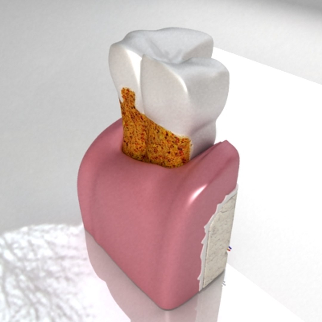 Tooth Dental Plaque 3d Model