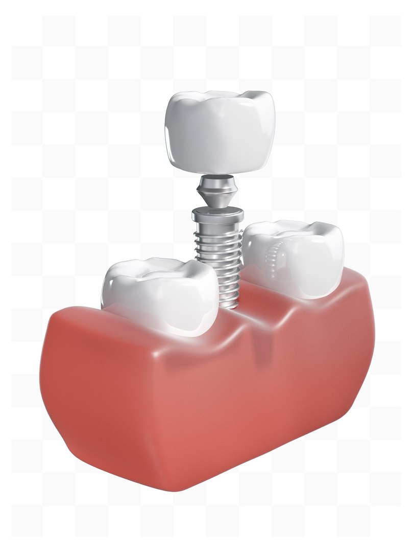 3D 3D gingival implant tooth detail 3D - TurboSquid 2049924